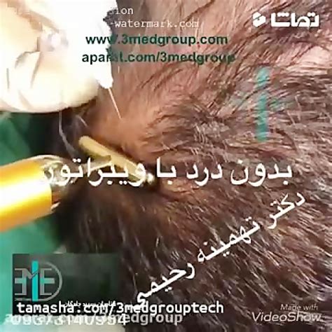 کربوکسی تراپی فن آوران سپید جامگان