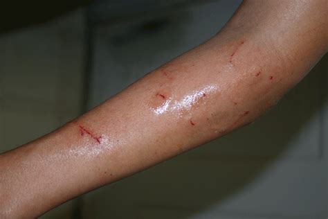 Mrsa Staph Infections Warning Signs And Preventive Measures Hubpages