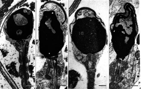 Acrosome And Chromatin Anomalies A Acrosomal Agenesis