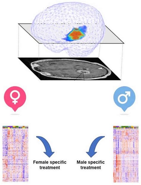 A Patient S Sex Matters When It Comes To Brain Cancer Neuroscience News