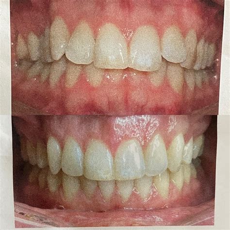 Im Done 2 Years 98 Trays 3 Rounds Of Refinements 2 Extractions Lots Of Ipr All Done To