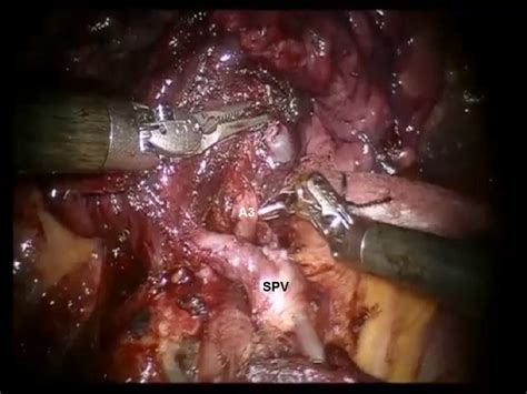 The Technique Of Robotic Anatomic Pulmonary Segmentectomy I Right Sided Segments
