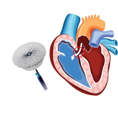 Vsd Device Closure Dr Raghu