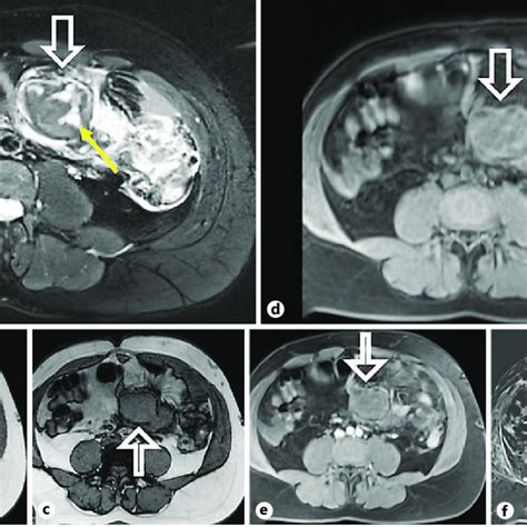 Mr Scans A F Showing The Mesenteric Mass Arrows With Internal