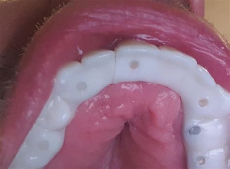 Dental Implants Gone Wrong
