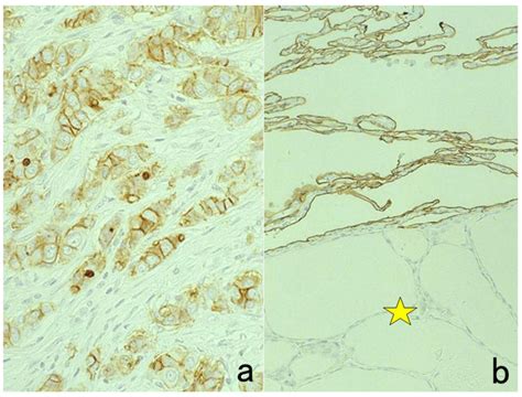 Plasma Membrane Localization Of Ki 67 A Breast Cancer And B Lung Download Scientific
