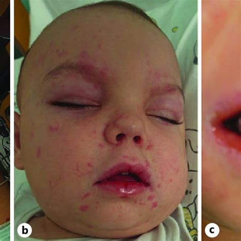 Clinical Features Of Mis C Erythematous Maculo Papular Rash On The Download Scientific Diagram