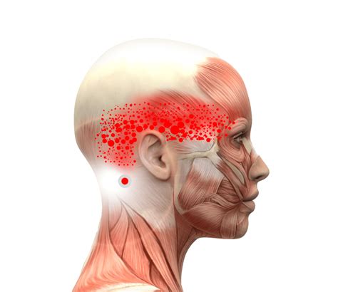 Trigger Point Therapy When To Seek Treatment Clinical Massage Brighton Inside Trigger Point Therapy When To Seek Treatment Clinical Massage Brighton Inside