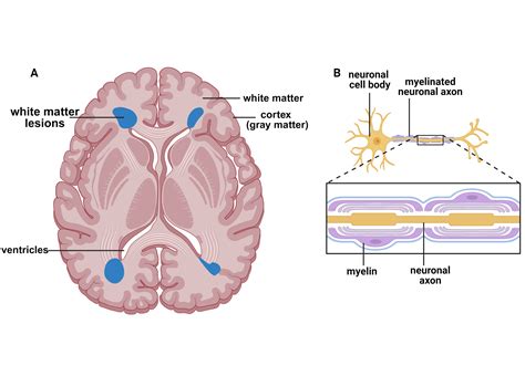 White Matter Anatomy