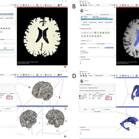 Segmentation Of The Brain Parenchyma And Lateral Ventricles With A Download Scientific Diagram