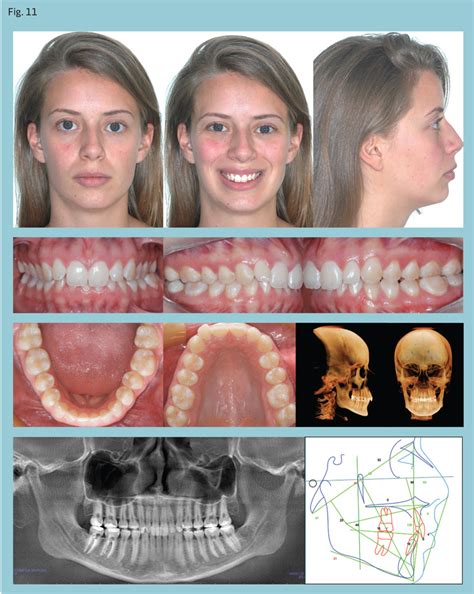 Simplified Correction Of Class Ii Using Powerscope By Alexandre Moro