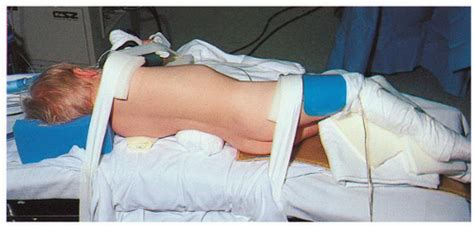 Hemivertebrae Excision Musculoskeletal Key