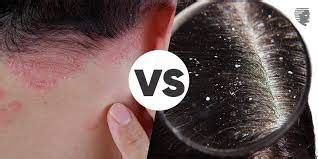 Scalp Psoriasis Vs Dandruff Understanding The Key Differences For Effective Treatment