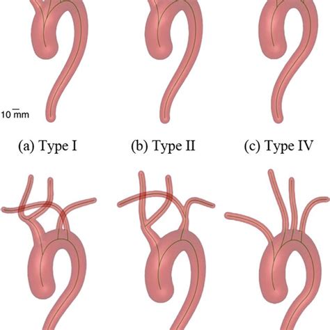 Aortic Arch Type Variations Available In The Aortic Arch Generator The