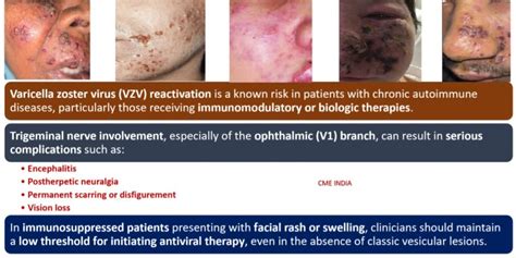 Uncommon Presentation Of The Herpes Zoster Shingles Along The