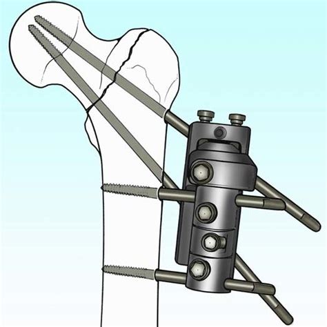 The Patient Is Positioned On A Fracture Table And Fracture Reduction Download Scientific