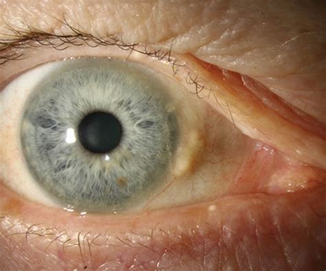 Sclera Disorders