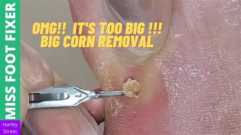 Its Too Big Big Corn Removal Miss Foot Fixer Youtube