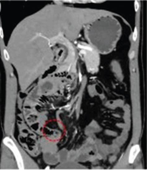 Ct Scan In Case 1 A There Was No Duodenal Horizontal Section The