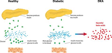 Topic Diabetic Ketoacidosis Dka Acls Ep Course Acls