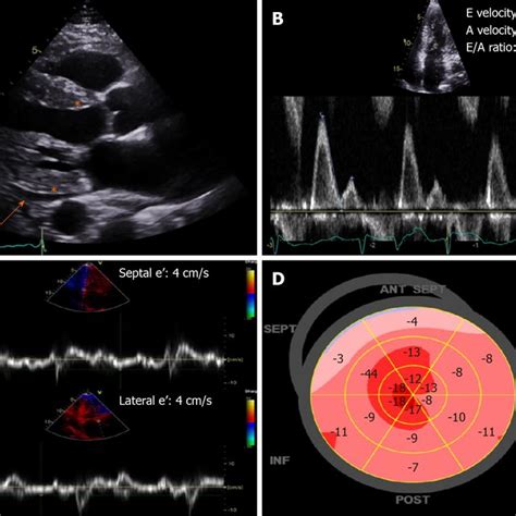 Tc 99m Pyrophosphate Spect Of The Chest With Computed Tomography Download Scientific Diagram