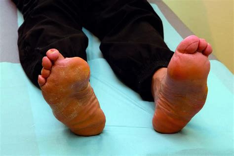 Diabetic Foot Amputation