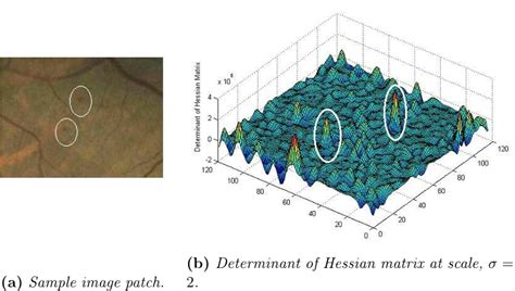 Figure 4 Response Of Hessian Operator Microaneurysms And Their
