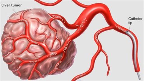 Chemoembolisation Treatment For Liver Tumors In Pune