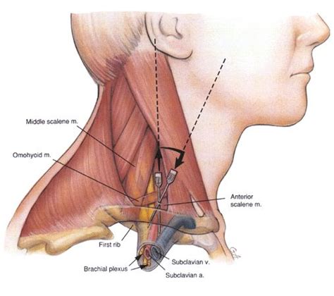 4 Methods Of Ultrasound Guided Brachial Plexus Block Cutting Edge Medical Equipment