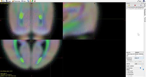 Finding The Fissure Calcarine In Neonate DTI Imaging Image Analysis