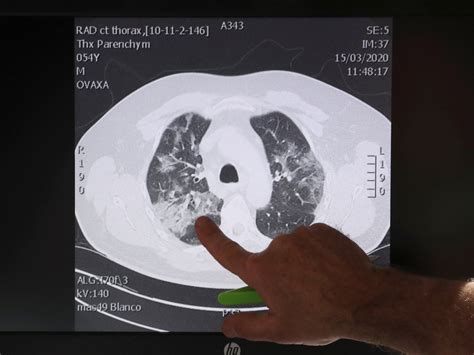 What Does Lung Scarring Look Like On Ct Scan Ct Scan Machine Imaging