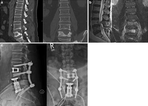 A Preoperative Ct Demonstrating A Pathologic Fracture Of L5 In A Download Scientific Diagram