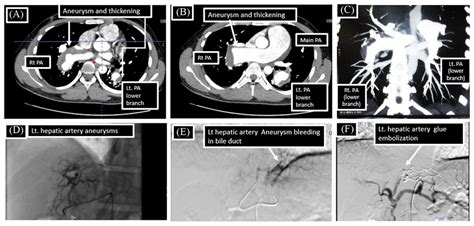 All Images Are Of Case 2 A Ctpa Showing Aneurysmal Dilatation And Download Scientific