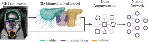 The Proposed Anatomy Informed Prostate Augmentation Simulating Typical