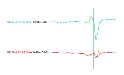 Advisor Hd Grid Mapping Catheter Sensor Enabled Abbott