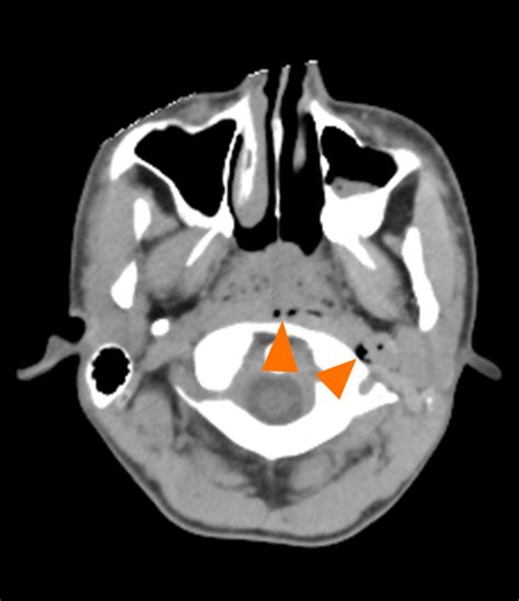 Head Computed Tomography Shows Emphysema In The Nasopharynx Download Scientific Diagram