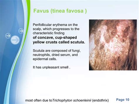 Tinea Capitis Ppt