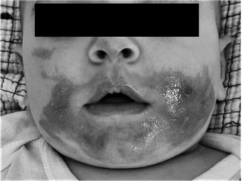 Parsnips And Phytophotodermatitis The Journal Of Pediatrics