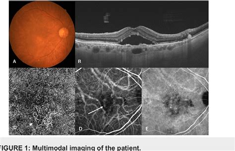 Figure 1 From Occlusion Of A Vortex Vein After Treatment With Half Fluence Photodynamic Therapy
