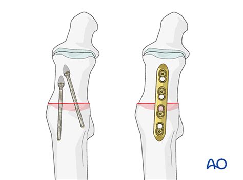 Mtp Joint Fusion For Complete Articular Fractures Of The Proximal Hallux
