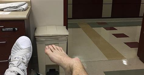 Subtalar Dislocation Album On Imgur