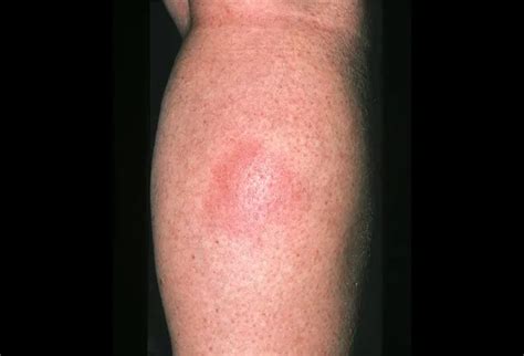 Erythema Nodosum Picture Image On