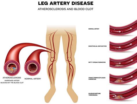 Peripheral Vascular Disease Stages Gday
