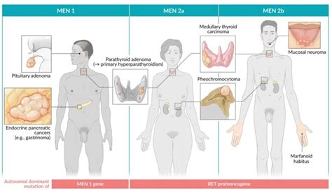 Multiple Endocrine Neoplasia Type 2b Men2b What Patients Should Know