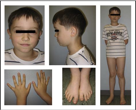 Macrocephaly Autism