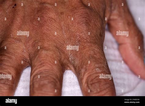 Hand Of A 62 Year Old Hispanic Female Patient Infected With Scabies