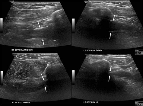 Imaging Brachial Plexus Pathology Applied Radiology