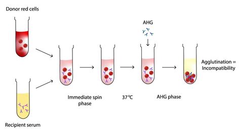 Serological Cross Matching A Blood Compatibility Test