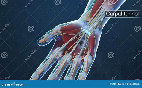 Carpal Tunnel Syndrome Is When The Median Nerve Is Compressed As It Passes Through The Carpal