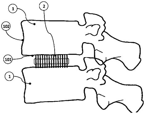 Intervertebral Medical Implant Eureka Patsnap